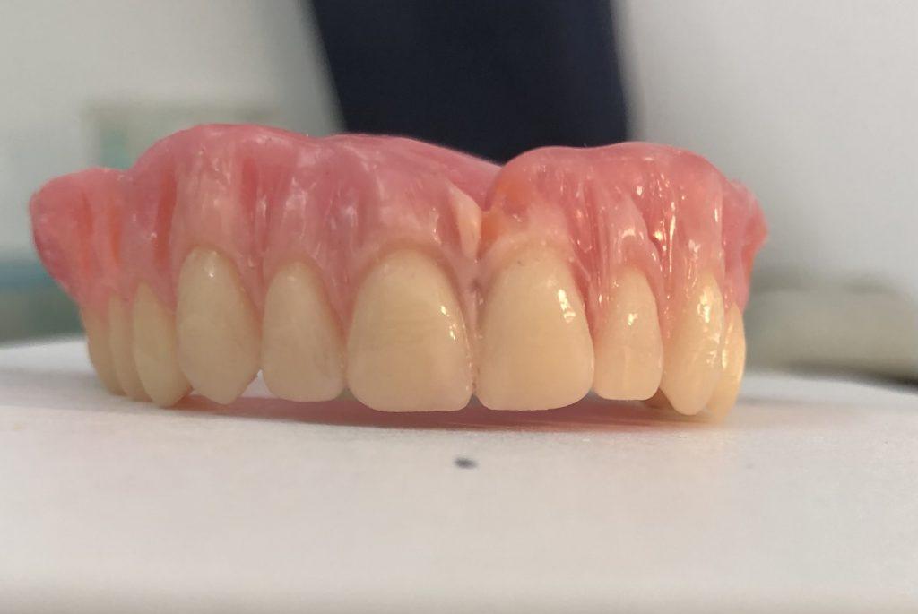 Totalna proteza kao dugoročno rješenje - denTBiH